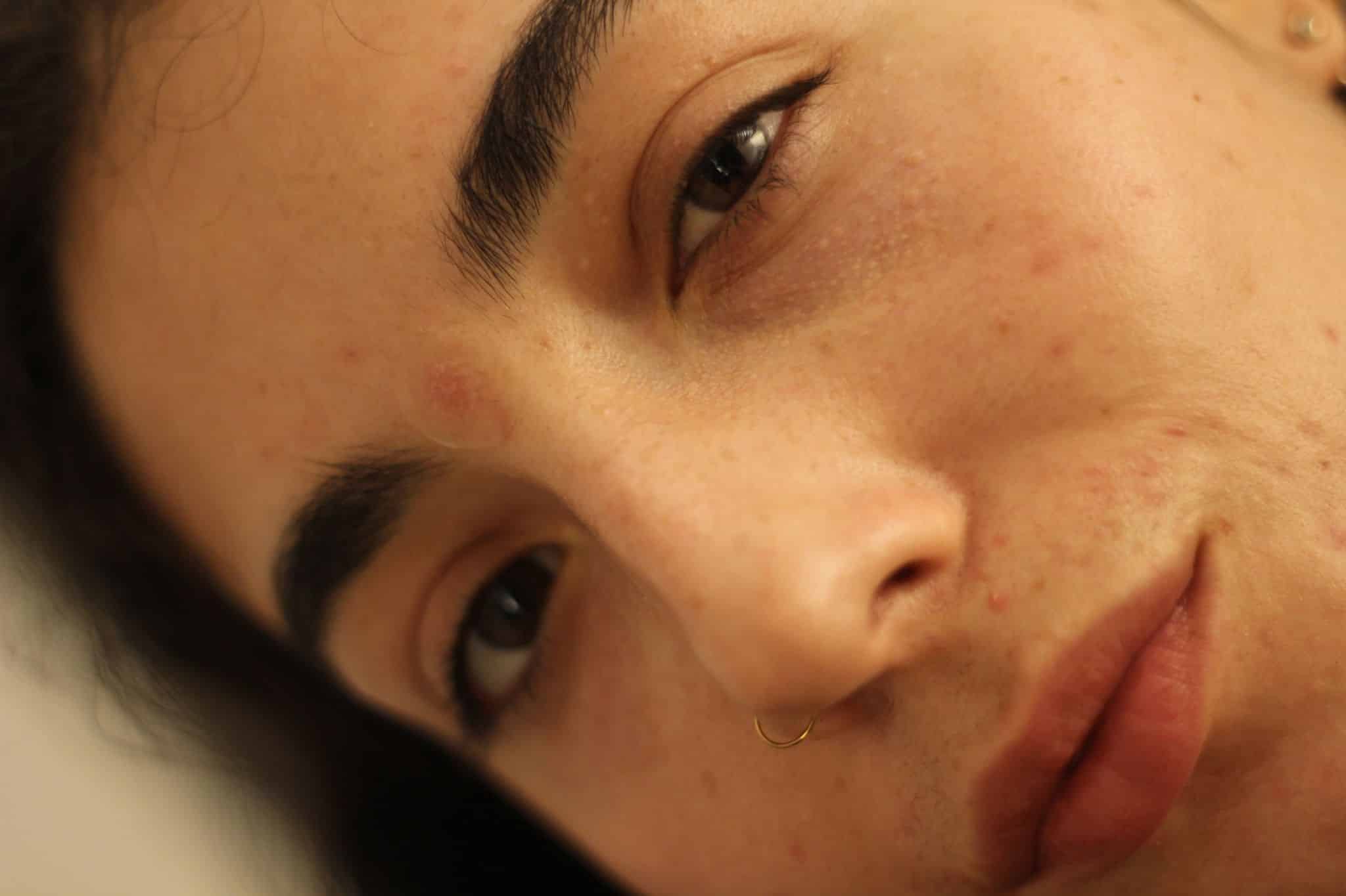 Is ZitSticka the answer to cystic spots? - Beauty and travel from ...