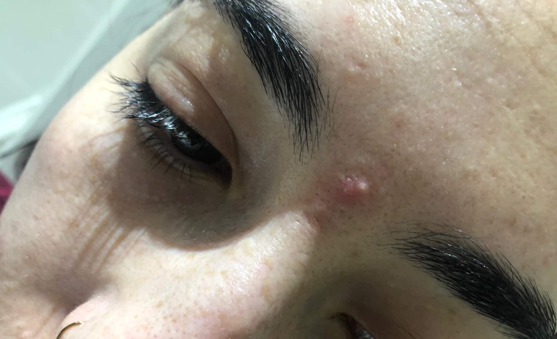 Is ZitSticka the answer to cystic spots? - Beauty and travel from ...