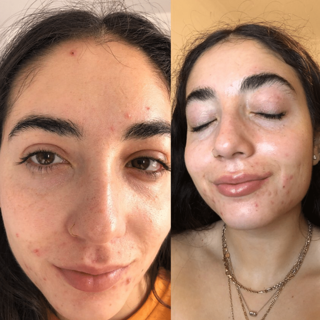 My Accutane journey and experience with isotretinoin - BREAKEVEN