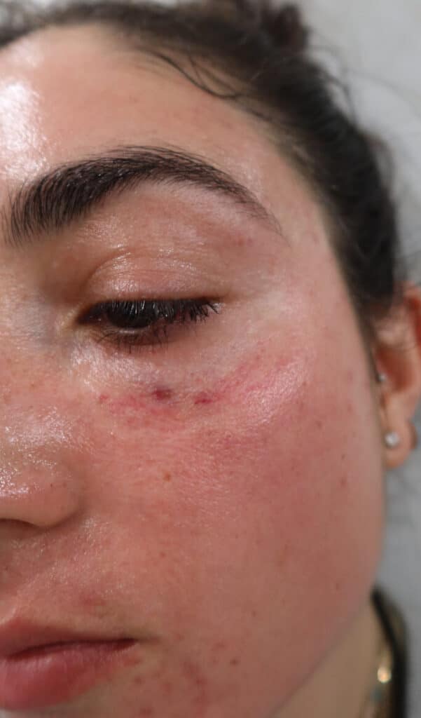 What 3 sessions of Microneedling + eye Mesotherapy look like (GR + ENG ...
